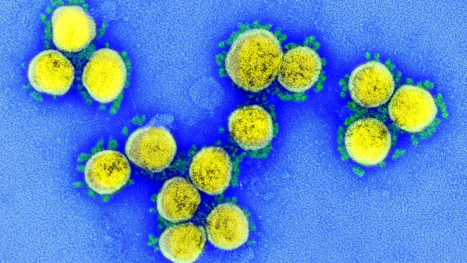 New SARS-CoV-2 neutralizing antibody enters clinical phase | German ...